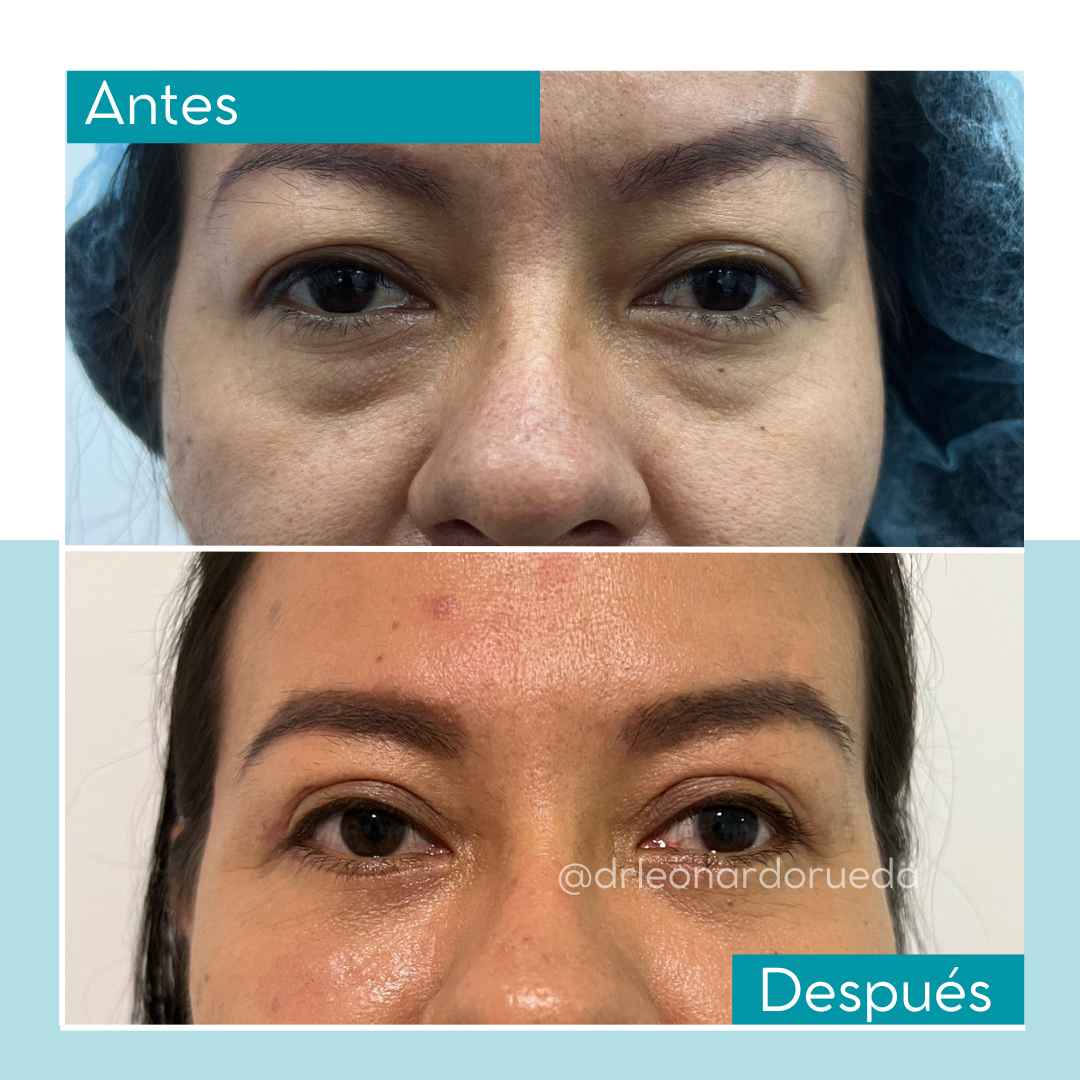 Rejuvenece tu rostro con Lifting Facial - Dr. Leonardo Rueda